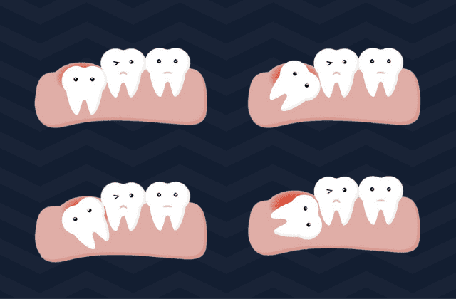Different Wisdom tooth positions